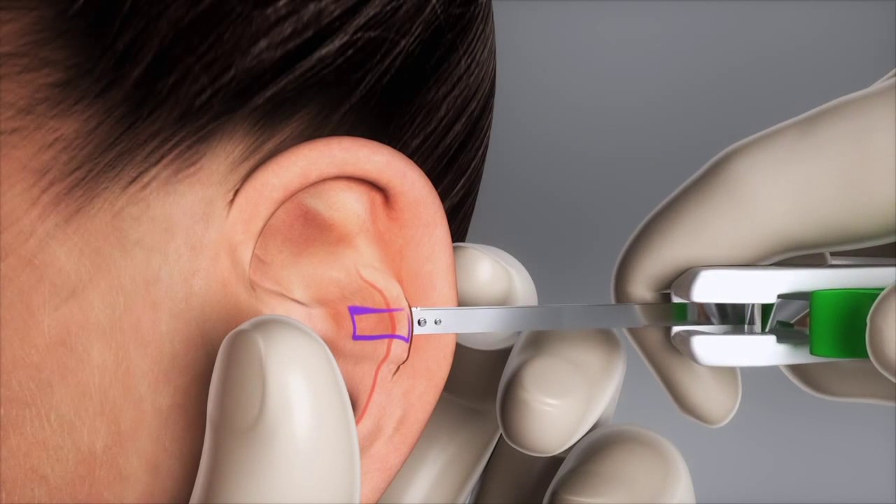 earfold-otoplastie-dr-wycisk - Docteur Wycisk